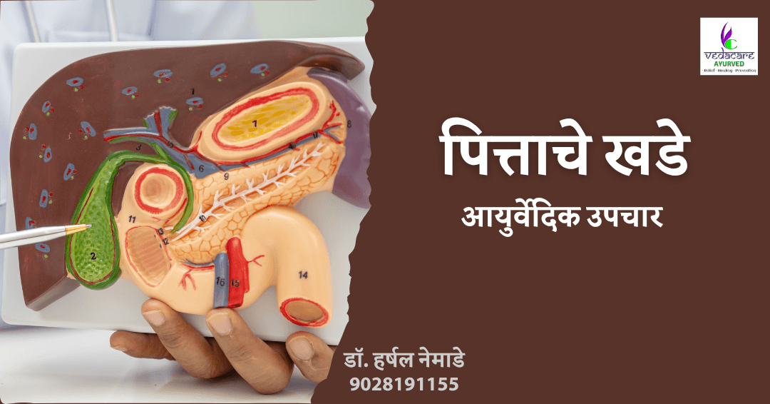 पित्ताशयाचे खडे (Cholelithiasis) व सूज (Cholecystitis) – आयुर्वेदिक ...