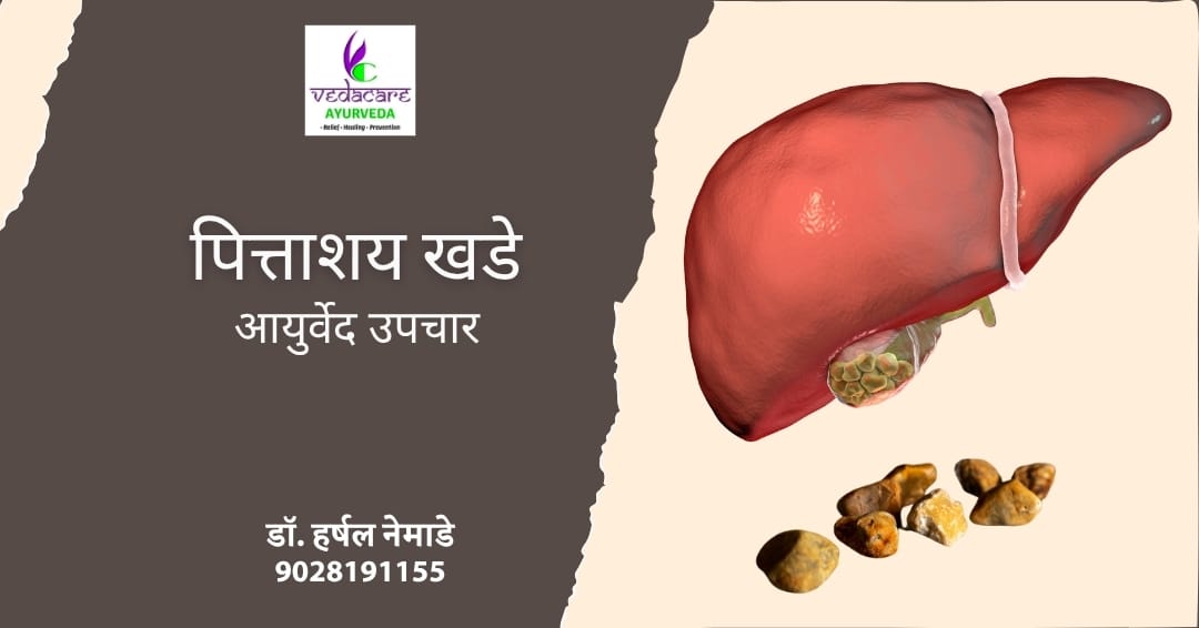 पित्ताशय खडे आयुर्वेद उपाय