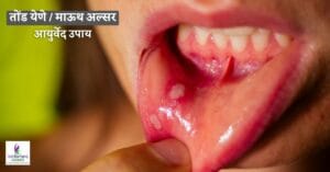 तोंड येणे (Mouth Ulcers) – आयुर्वेदिक कारणे, उपाय व पंचकर्म
